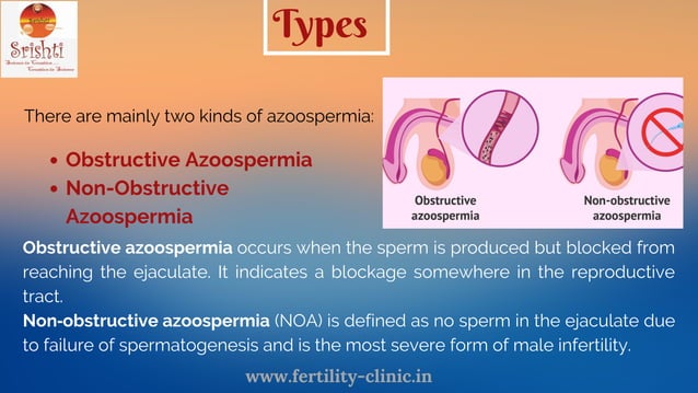 Azoospermia: Causes, Diagnosis and Treatment | PDF