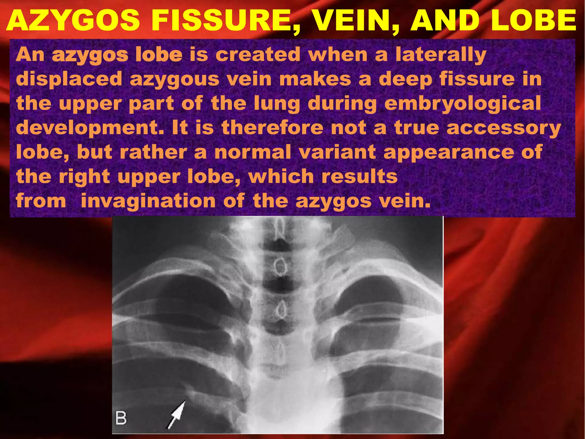Azygos fissure, vein, and lobe | PPTX