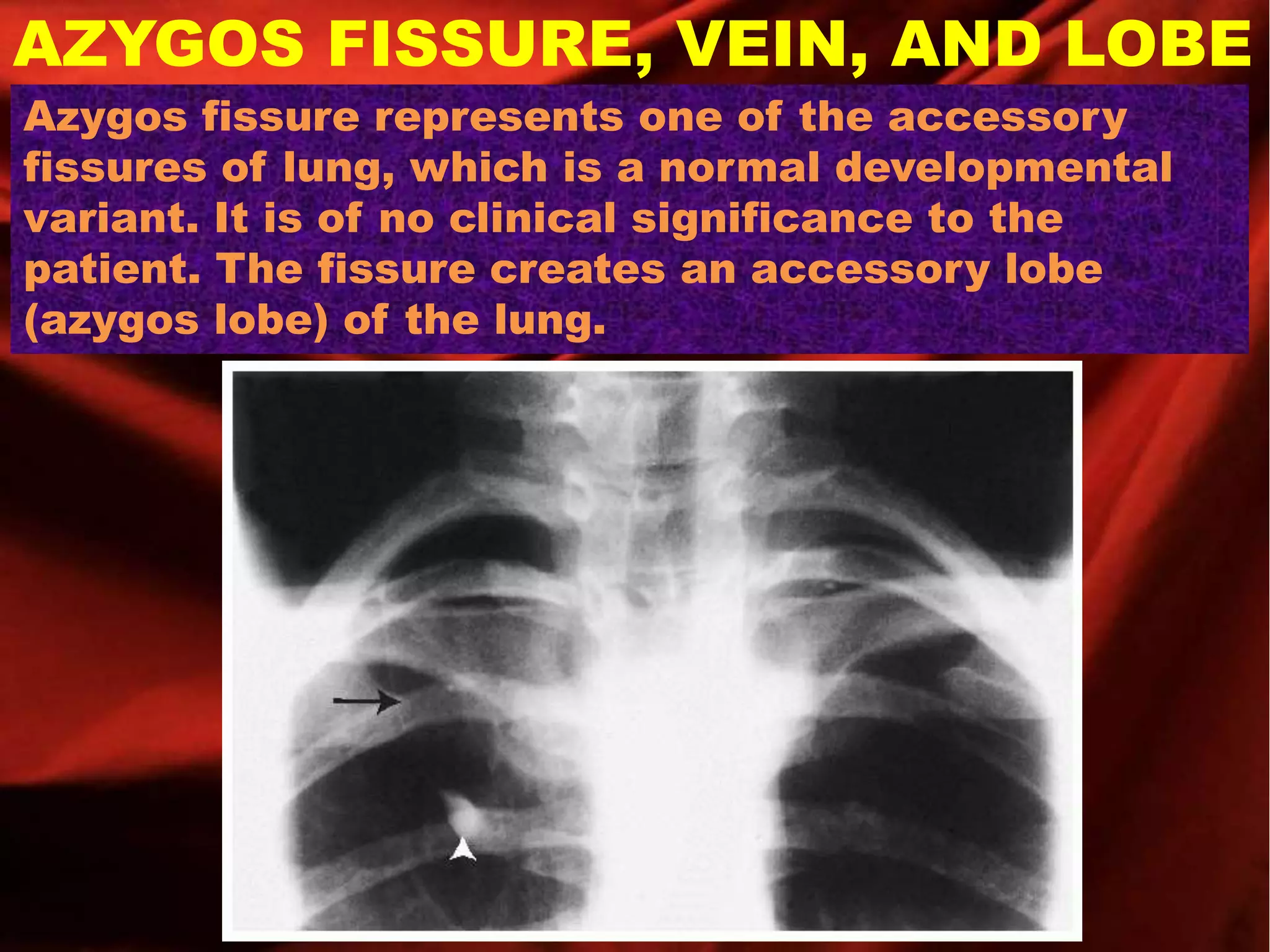 Azygos fissure, vein, and lobe | PPTX