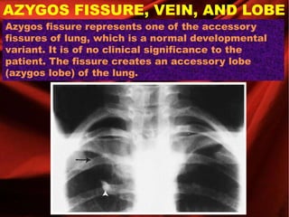 Azygos fissure, vein, and lobe | PPTX