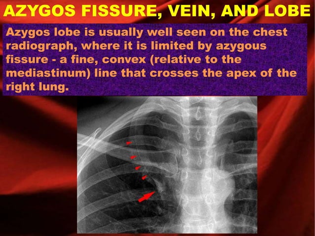 Azygos fissure, vein, and lobe | PPTX