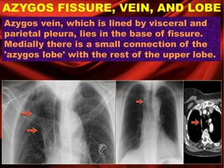 Azygos fissure, vein, and lobe | PPTX