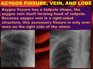 Azygos fissure, vein, and lobe | PPTX