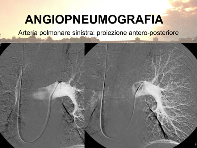 Imaging con Angiografia Polmonare | PPT