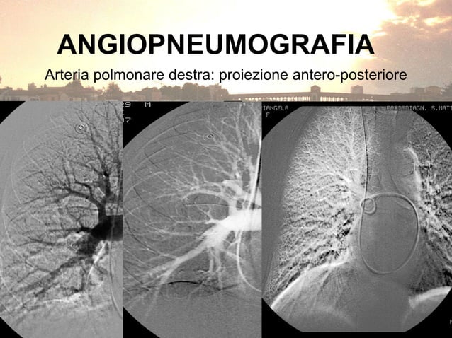 Imaging con Angiografia Polmonare | PPT