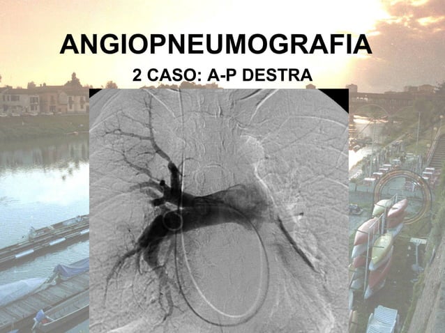 Imaging con Angiografia Polmonare | PPT