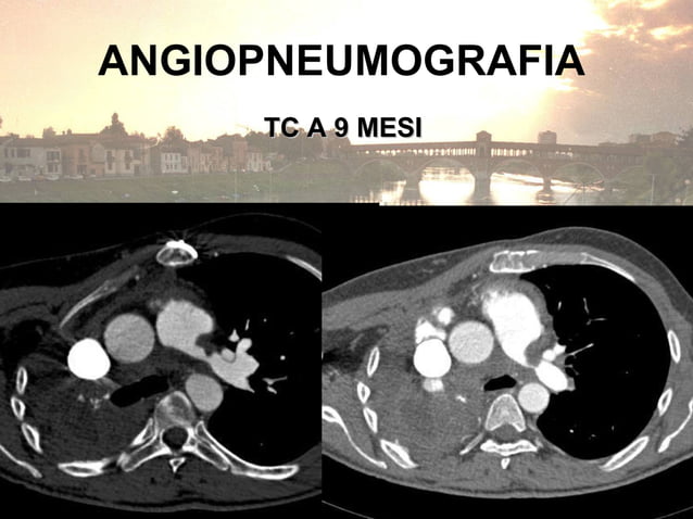 Imaging con Angiografia Polmonare | PPT | Free Download