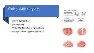 Cleft lip & palate | PDF