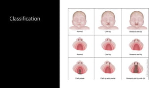 Cleft lip & palate | PDF