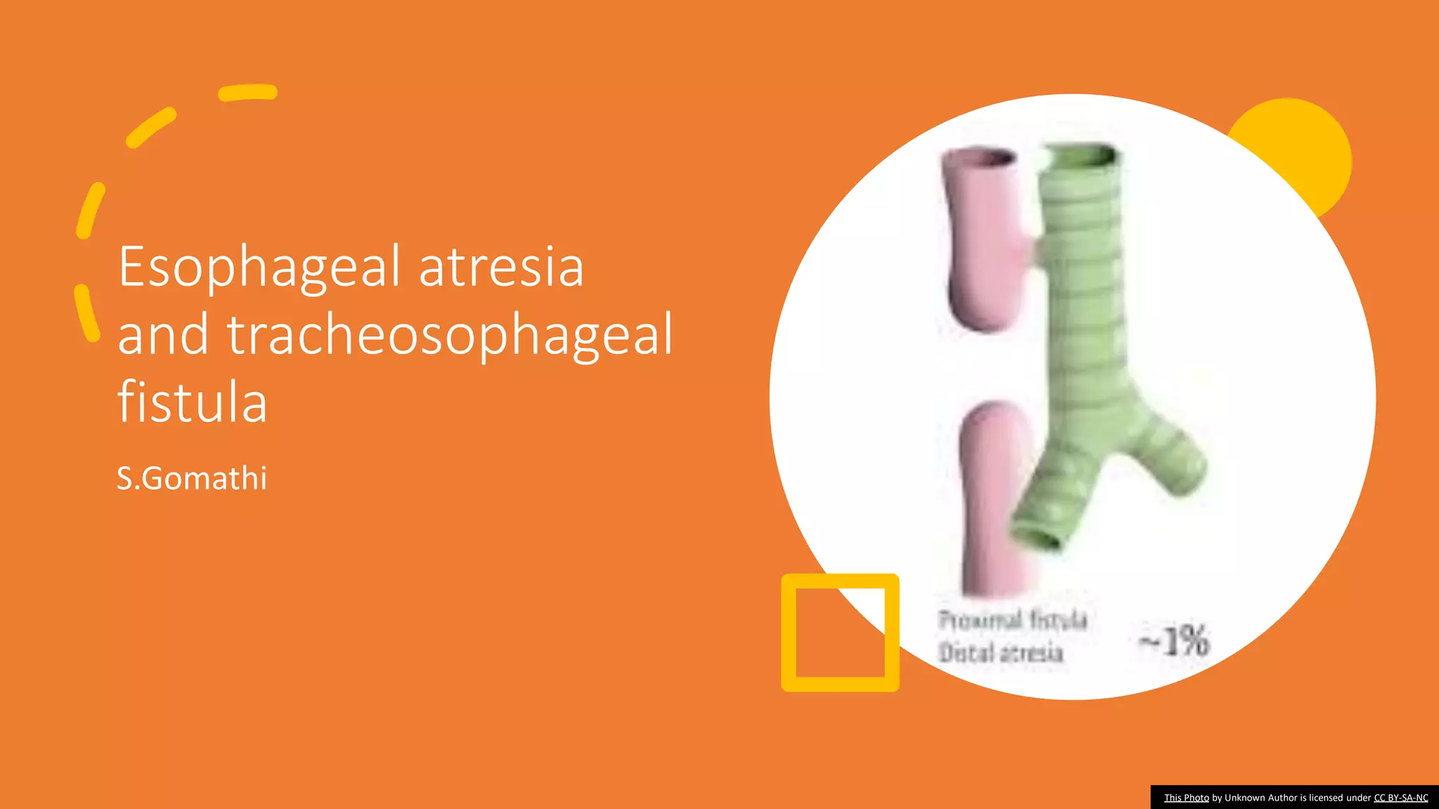 Tracheoesophageal fistula | PPT