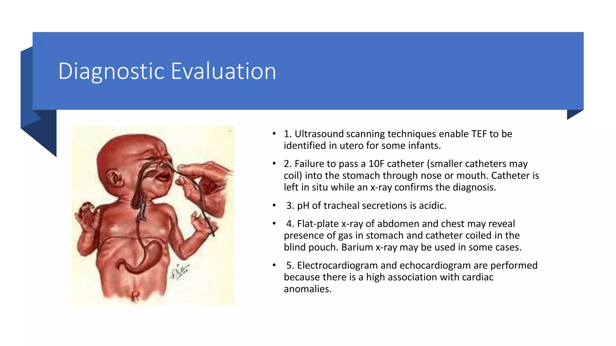 Tracheoesophageal fistula | PPT