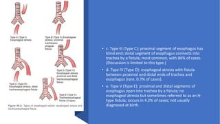 Tracheoesophageal fistula | PPT
