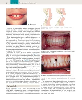 Retromolar Region