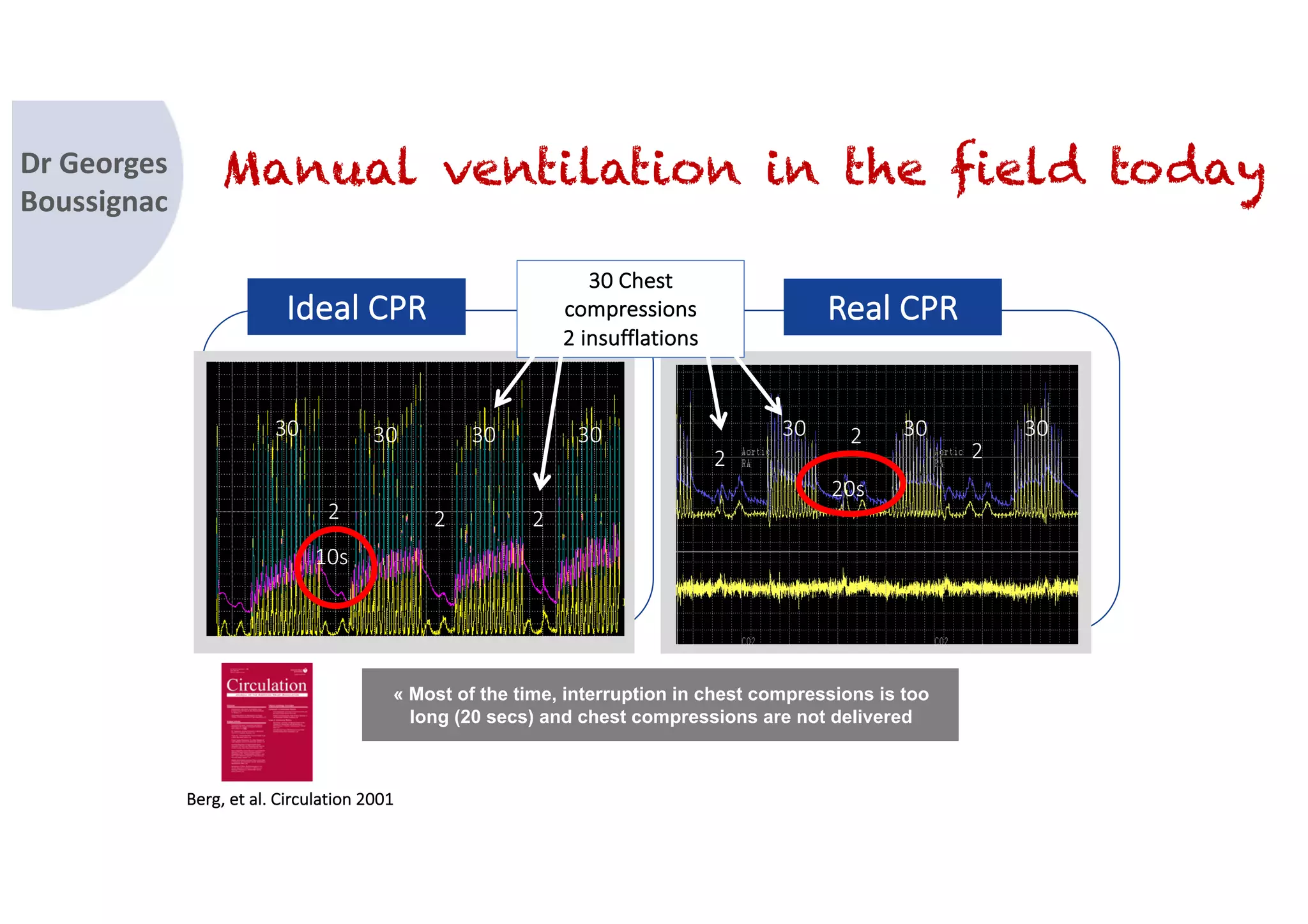 RCP Alveoli Ventilation with Continuous Chest Compression - b-card ...