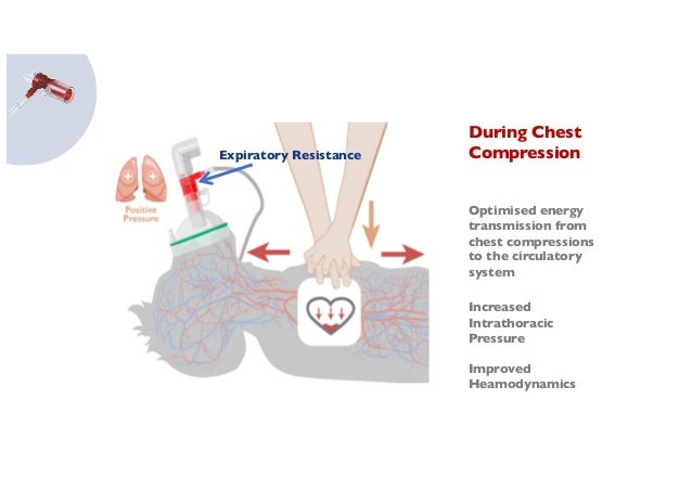 RCP Alveoli Ventilation with Continuous Chest Compression - b-card co…