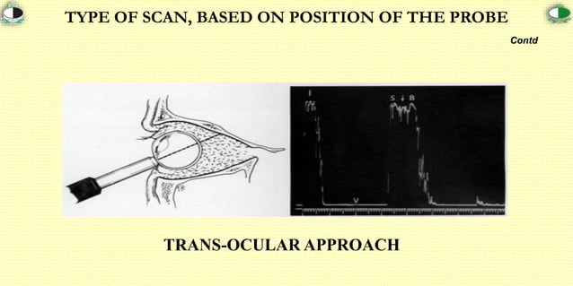 BScan and Ascan in ophthalmology and eye field | PPTX | Eye and Vision ...