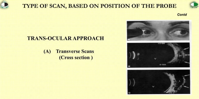 BScan and Ascan in ophthalmology and eye field | PPTX | Eye and Vision ...