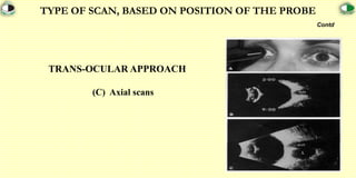 BScan and Ascan in ophthalmology and eye field | PPTX | Eye and Vision ...