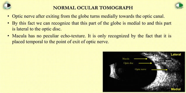 BScan and Ascan in ophthalmology and eye field | PPTX | Eye and Vision ...