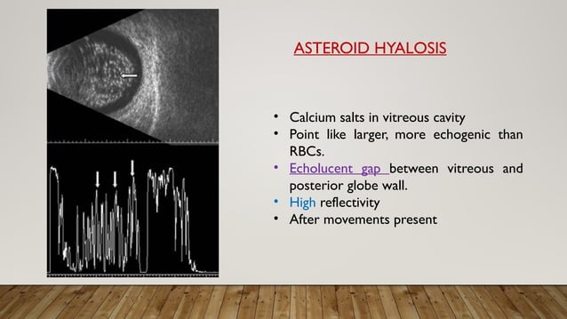 B-Scan procedure basics in ophthalmology.pptx