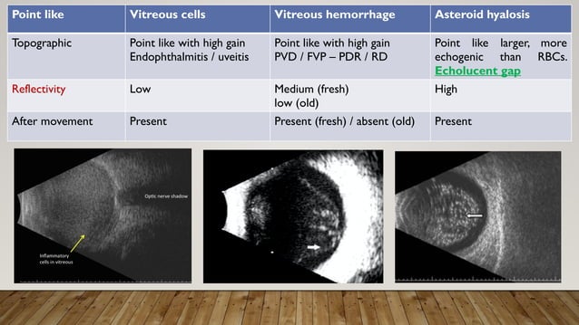 B-Scan procedure basics in ophthalmology.pptx