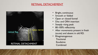 B-Scan procedure basics in ophthalmology.pptx