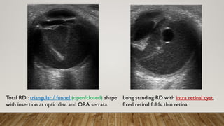 B-Scan procedure basics in ophthalmology.pptx