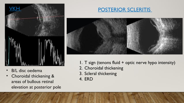 B-Scan procedure basics in ophthalmology.pptx