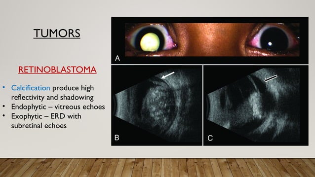 B-Scan procedure basics in ophthalmology.pptx