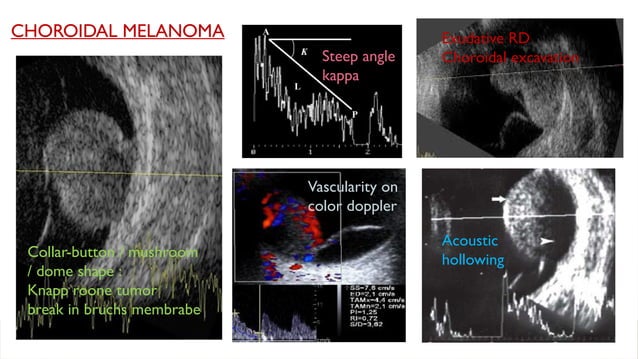 B-Scan procedure basics in ophthalmology.pptx