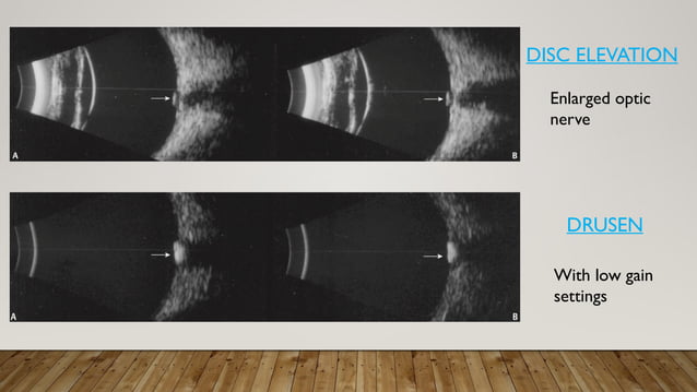B-Scan procedure basics in ophthalmology.pptx