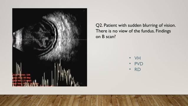 B-Scan procedure basics in ophthalmology.pptx