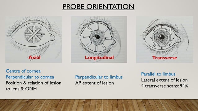 B-Scan procedure basics in ophthalmology.pptx
