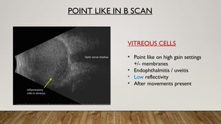 B-Scan procedure basics in ophthalmology.pptx