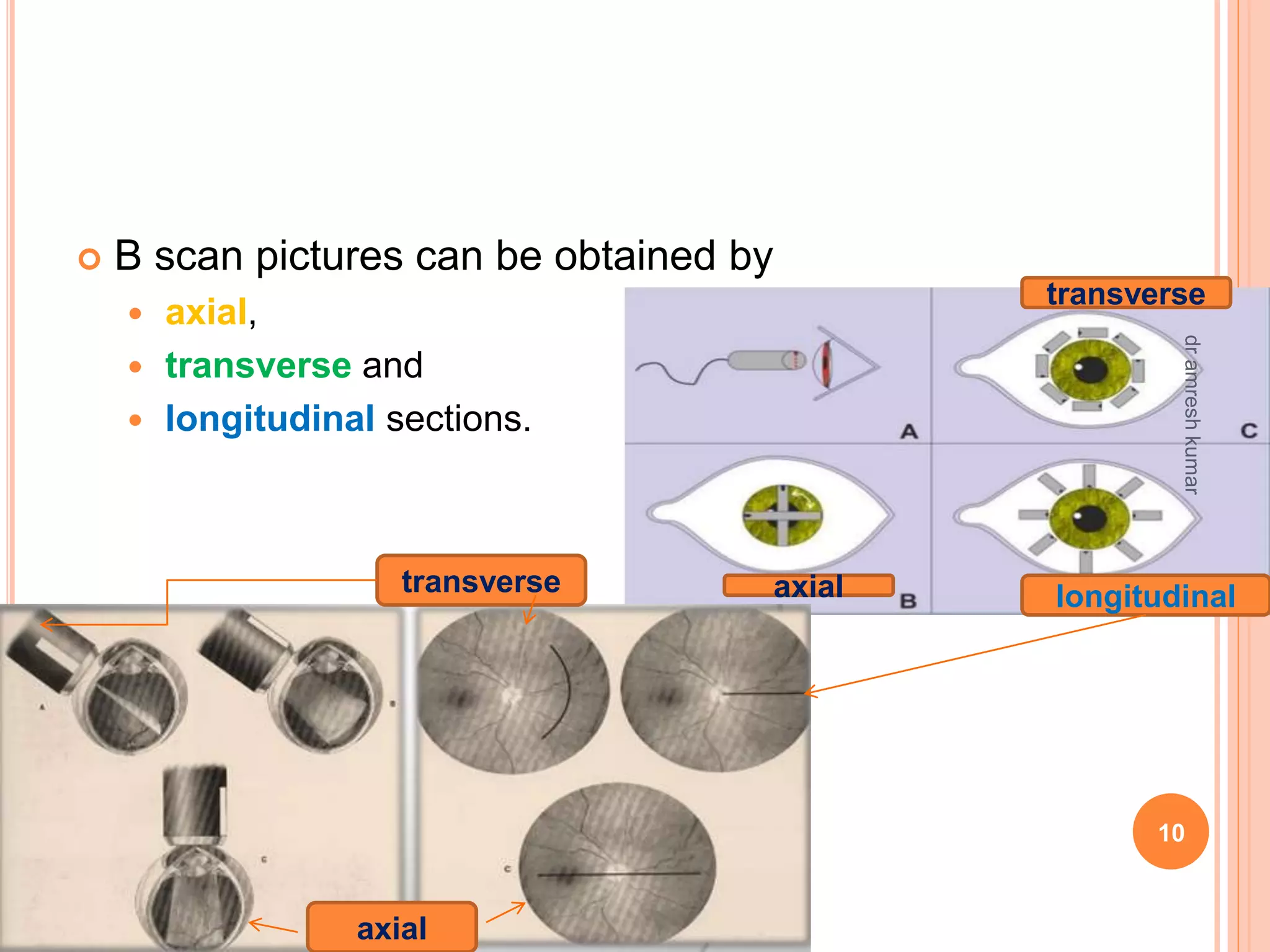 B-SCAN IN OPHTHALMOLOGY.pptx