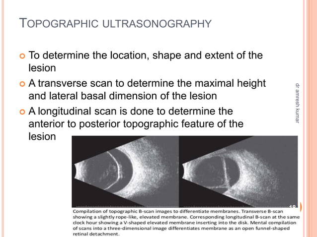 B-SCAN IN OPHTHALMOLOGY.pptx