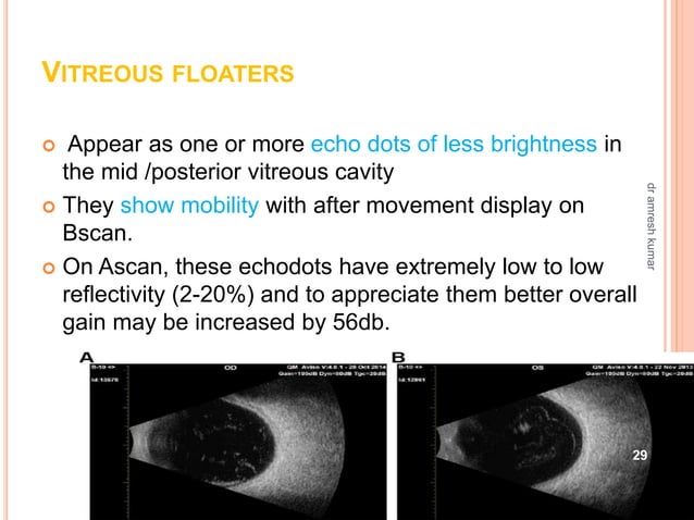B-SCAN IN OPHTHALMOLOGY.pptx