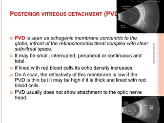B-SCAN IN OPHTHALMOLOGY.pptx