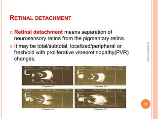 B-SCAN IN OPHTHALMOLOGY.pptx