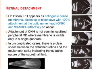B-SCAN IN OPHTHALMOLOGY.pptx