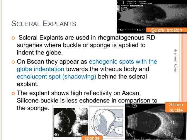 B-SCAN IN OPHTHALMOLOGY.pptx