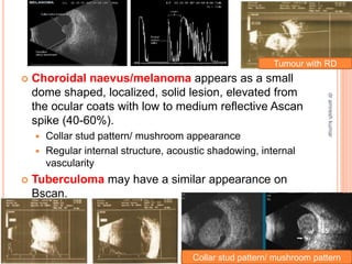 B-SCAN IN OPHTHALMOLOGY.pptx