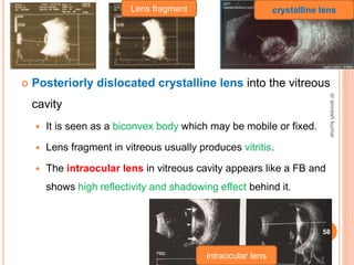 B-SCAN IN OPHTHALMOLOGY.pptx