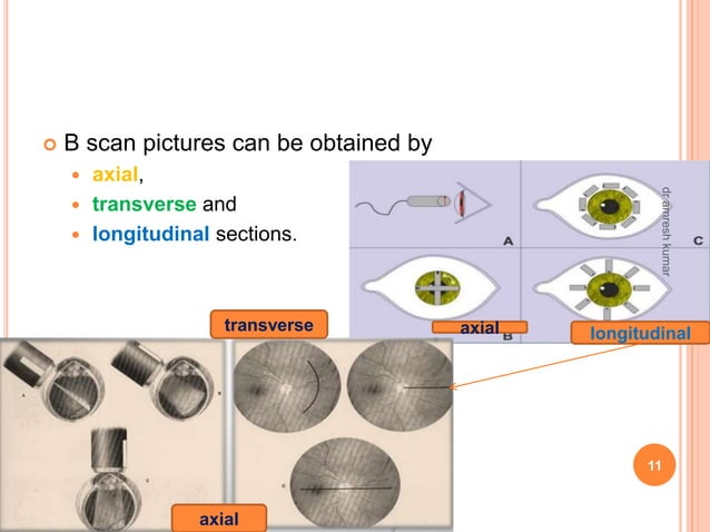 B-SCAN IN OPHTHALMOLOGY.pptx | Eye and Vision Conditions | Diseases and ...