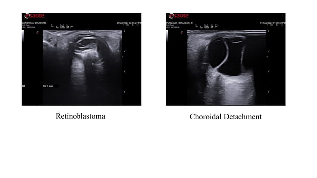 B-scan paper for occular diseases diagnosis.pptx