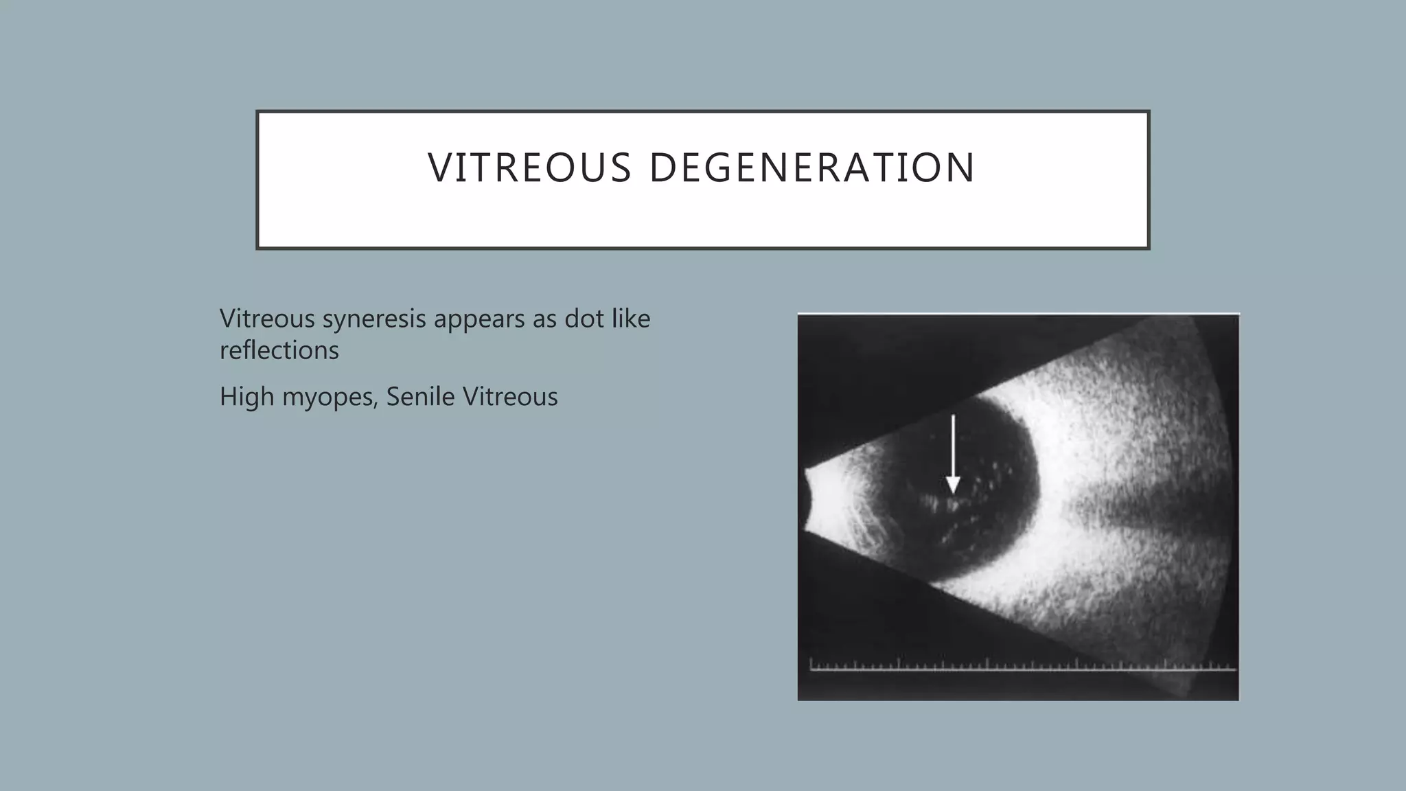 B scan ultrasonography | PPTX