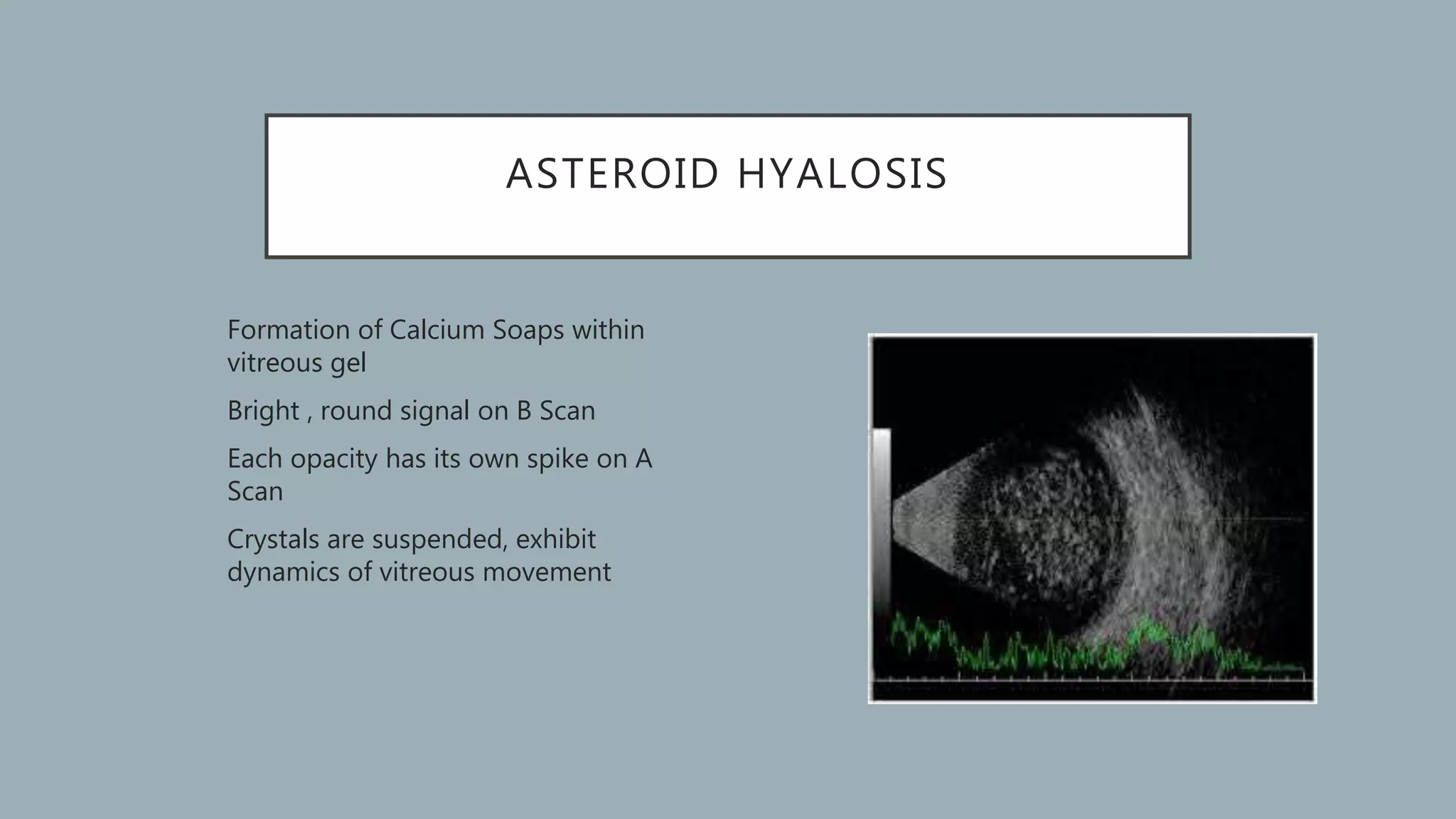 B scan ultrasonography | PPTX