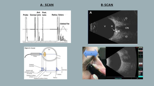 B scan ultrasonography | PPTX
