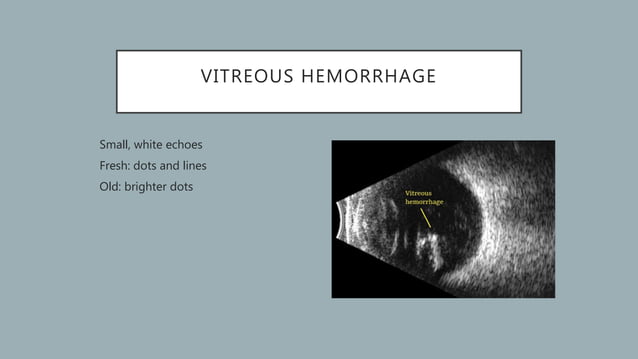 B scan ultrasonography | PPTX