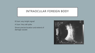 B scan ultrasonography | PPTX